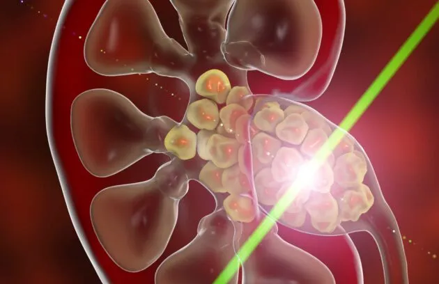 Medpark: Tratament inovativ pentru pietrele la rinichi